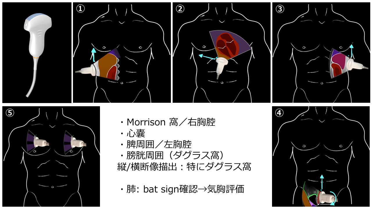 外傷初期治療でのエコーを伝授！extended FASTとその向こうへ【画像あり】 | 救急医の頭ん中。