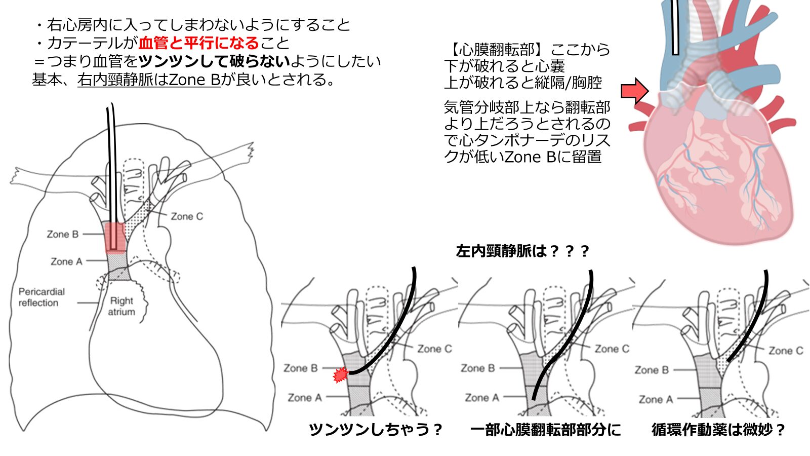中心静脈カテーテル挿入｜セリジンガー法＆超音波ガイド完全マニュアル【第2章：手技編】 | 救急医の頭ん中。